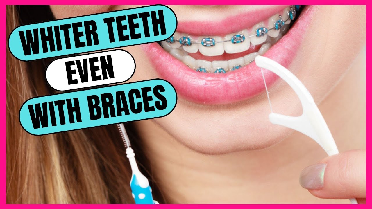 Best Methods For Keeping Teeth White With Braces - YouTube