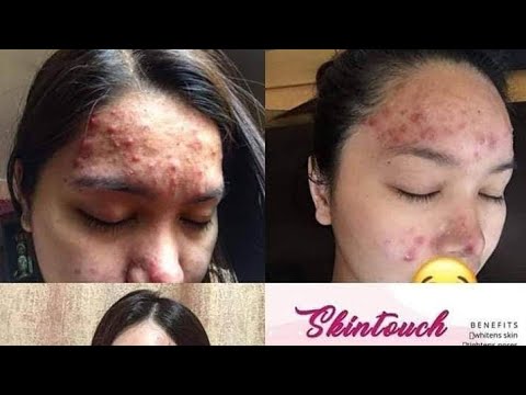 Skin touch rejuv set A Honest review - YouTube