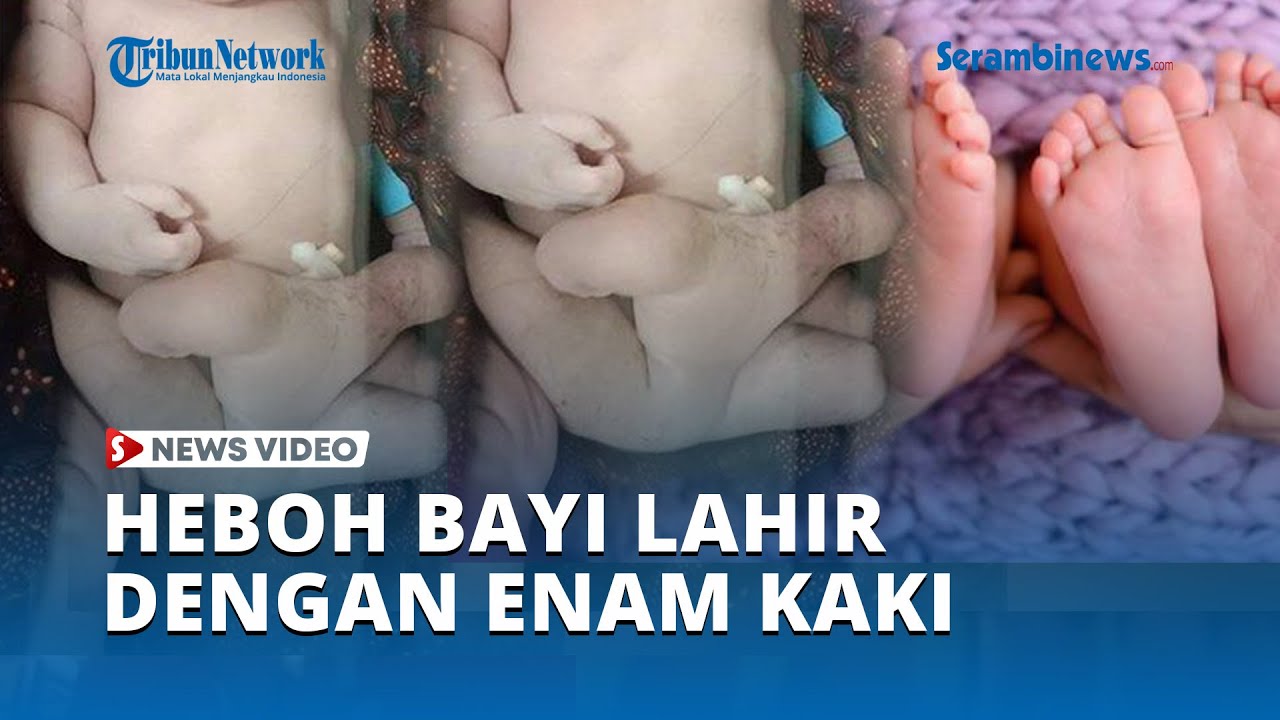 HEBOH Bayi di Lombok Lahir dengan Enam Kaki, Ini Penjelasan Dokter ...