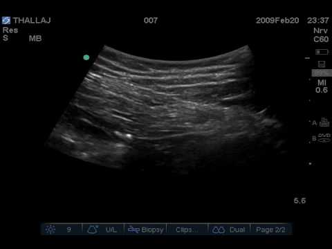 ultrasound guided transgluteal sciatic nerve block - YouTube