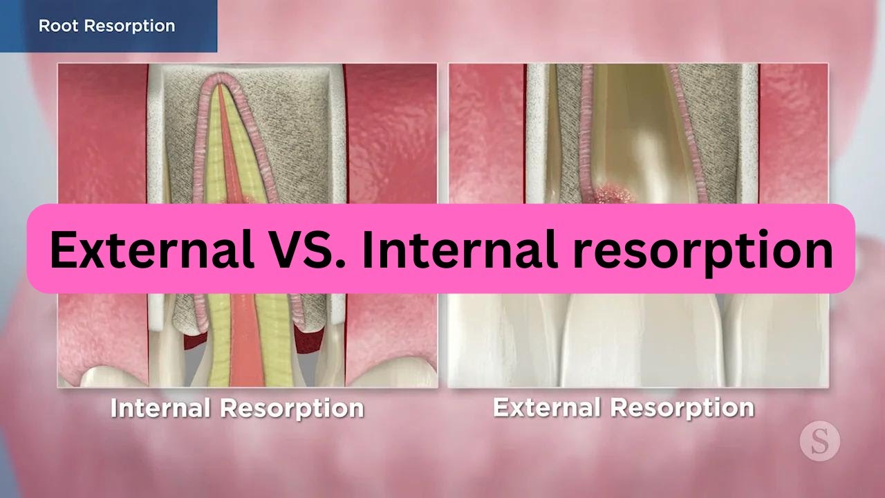 External Resorption Vs Internal Resorption