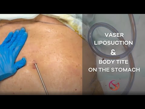 Vaser Liposuction and BodyTite on the Stomach | Dr. Shalini Gupta - YouTube