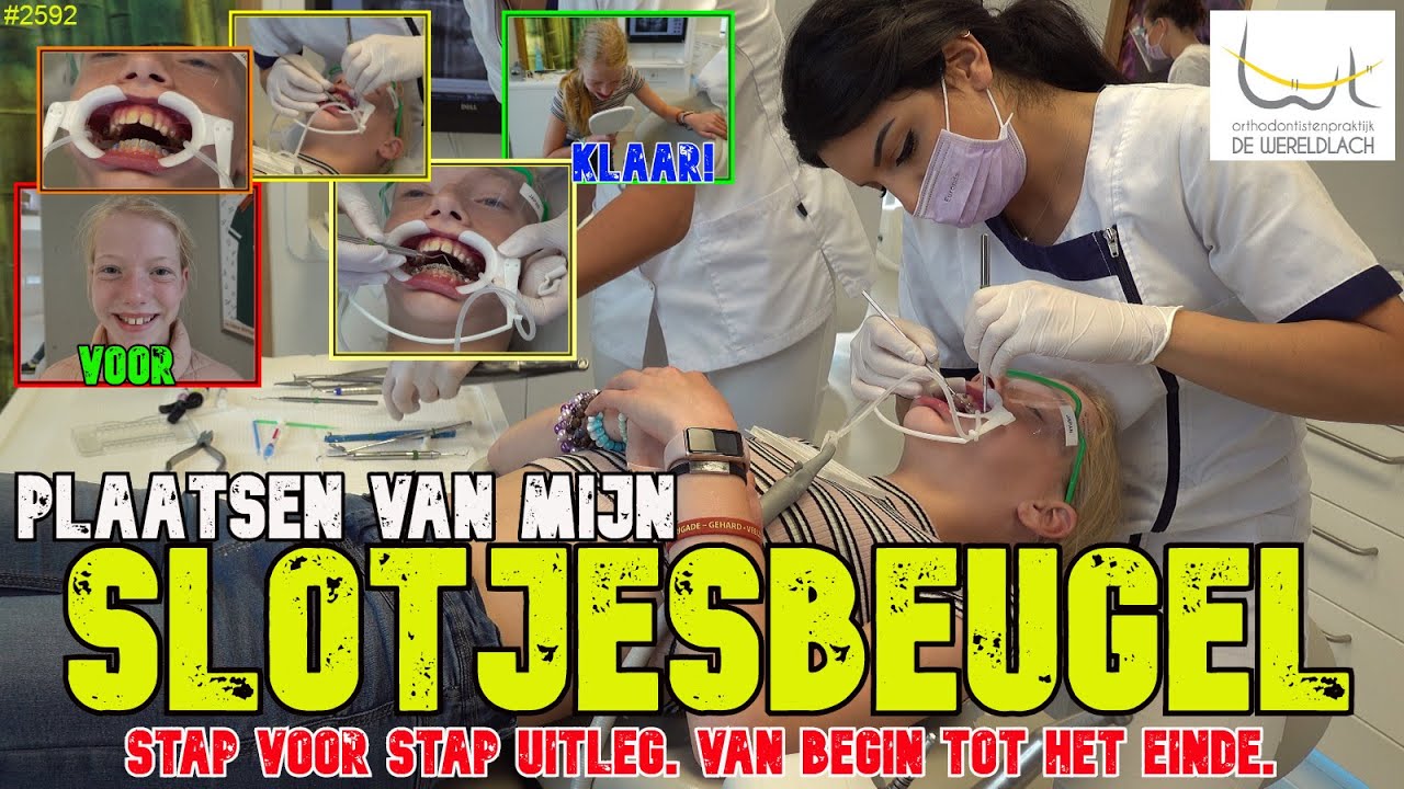 IK KRIJG MIJN BEUGEL. SLOTJESBEUGEL plaatsen door ORTHODONTIST, Stap ...