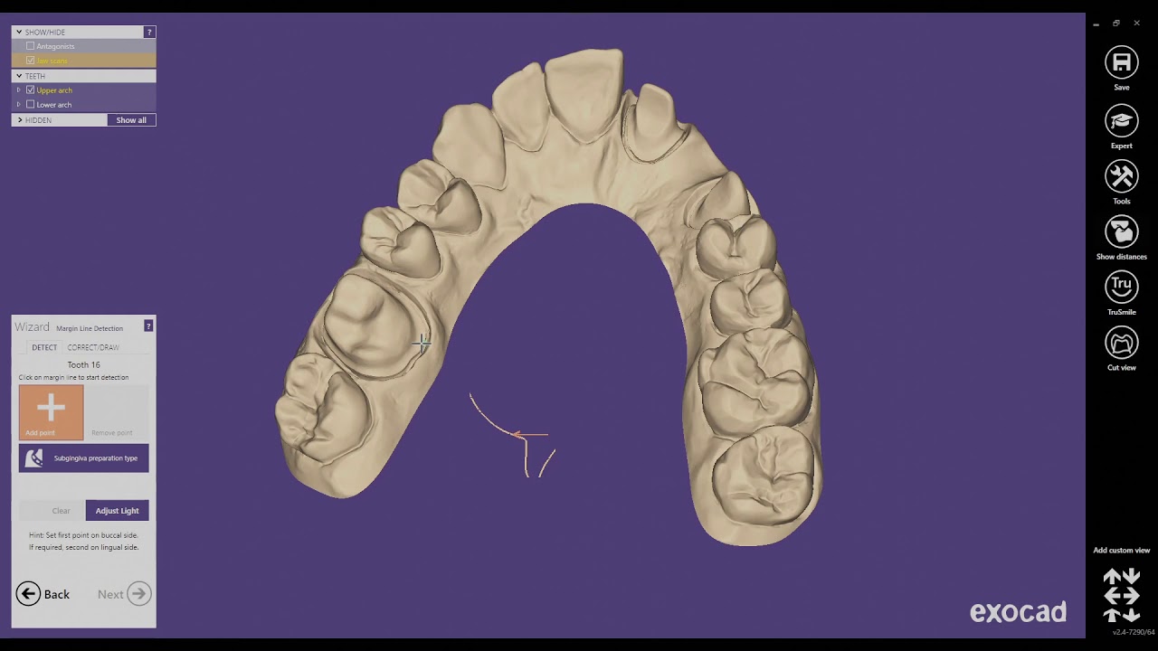 Form 3B - Removable Die Models in ExoCAD Model Creator - YouTube