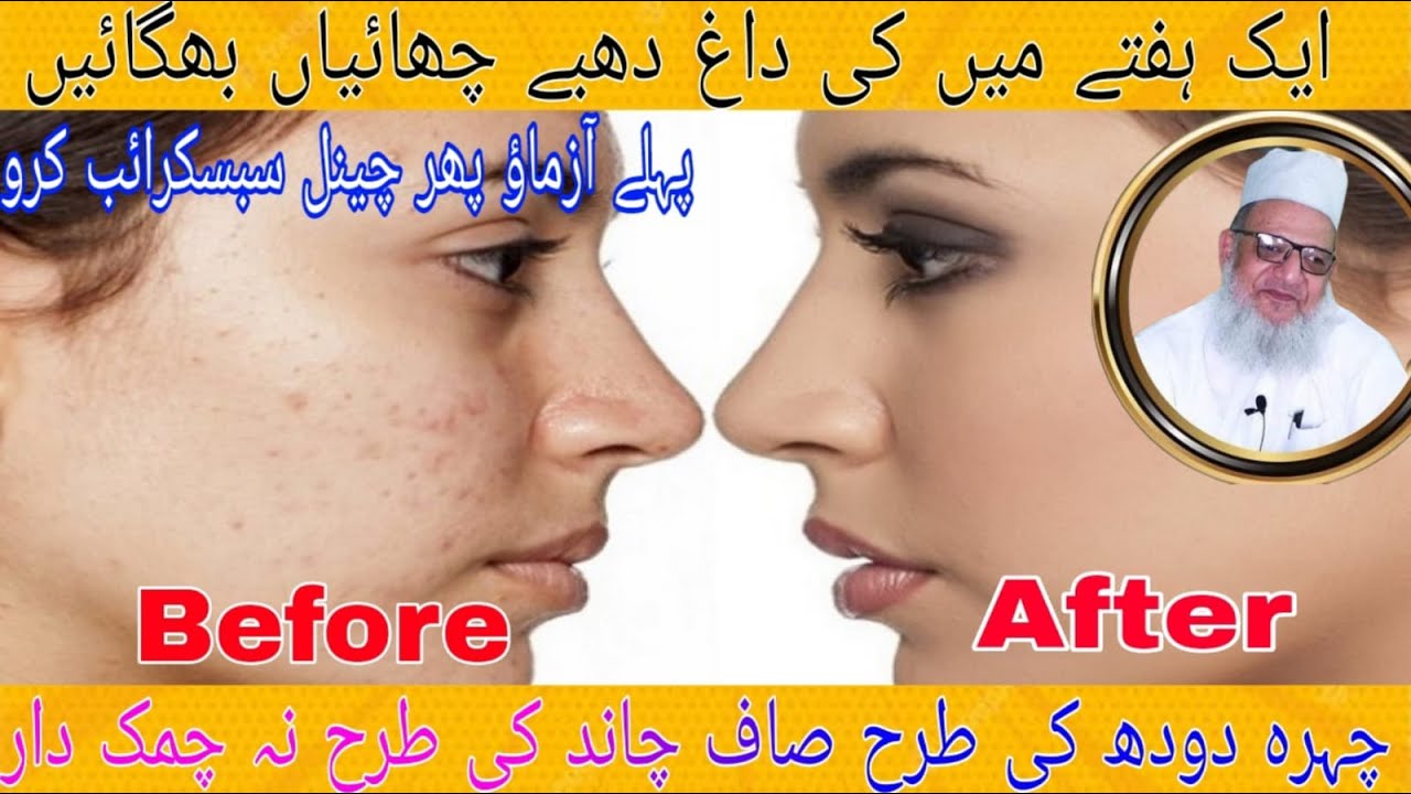 How to remove blemishes from face.Chehre ke daag dhabbe chaiyan khatm ...