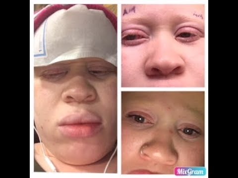Albinism and strabismus surgery - YouTube