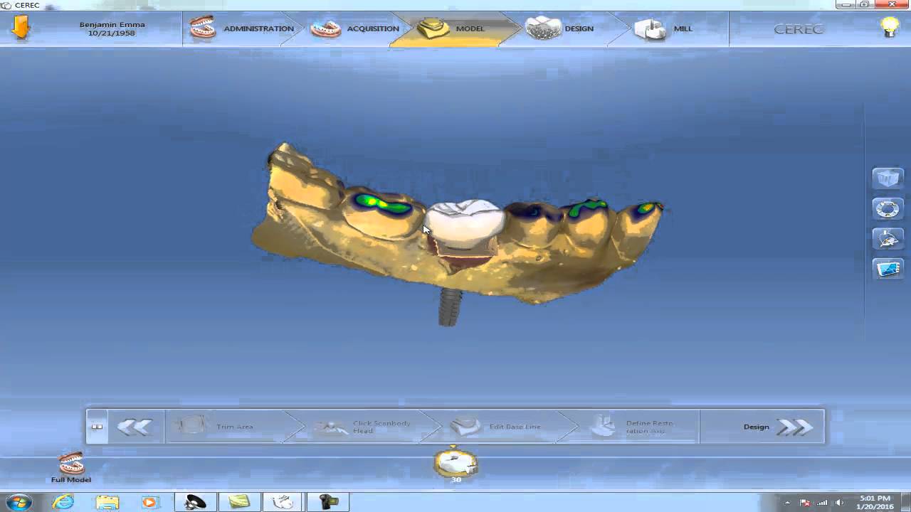 Designing Implant Crowns in 4 4 CEREC Chairside Software - YouTube