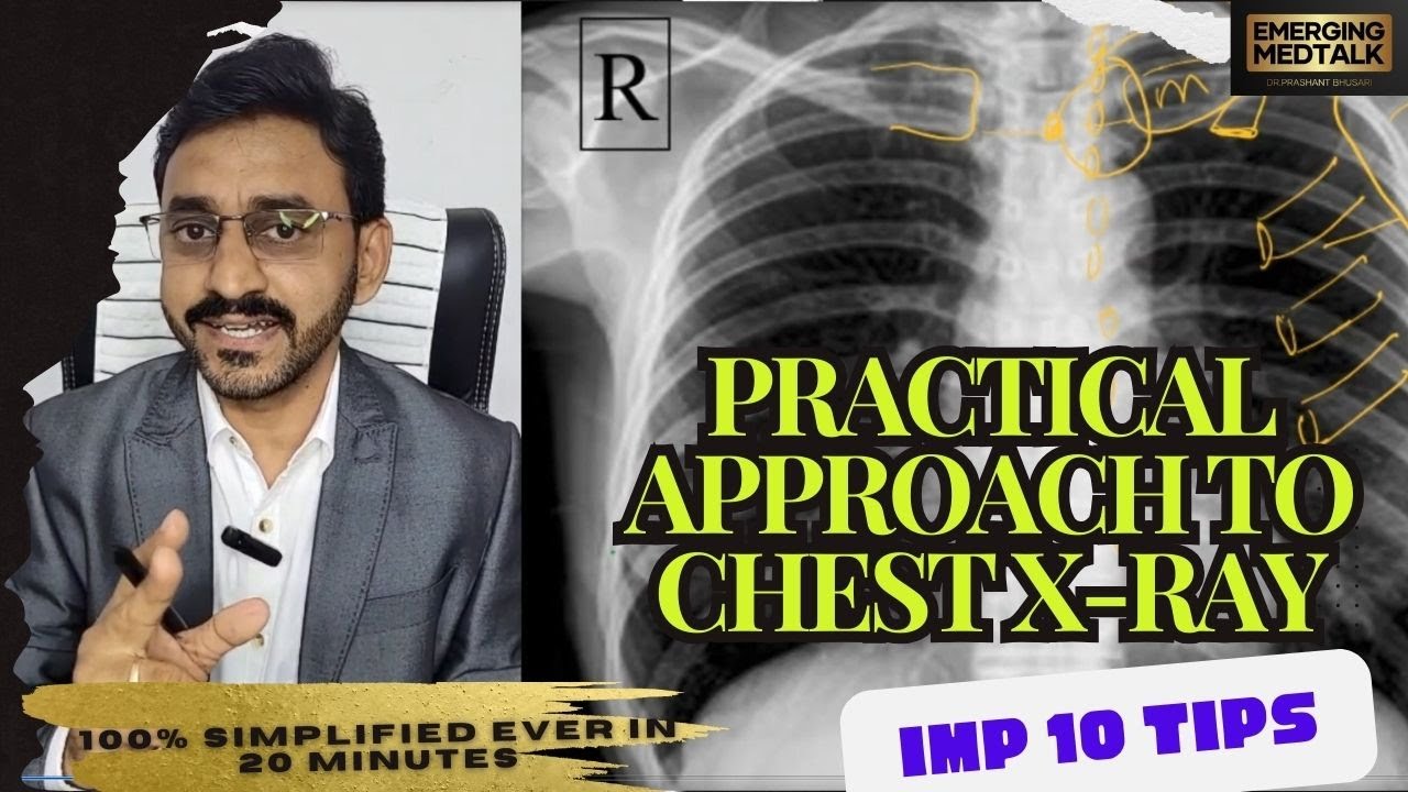 PRACTICAL APPROACH TO CHEST X RAY -10 IMPORTANT TIPS - YouTube