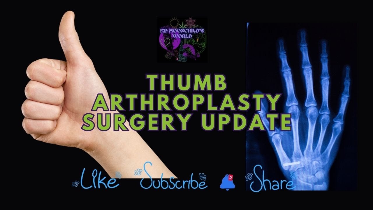 Thumb Arthroplasty Surgery Update #1 | December 21, 2023 - YouTube