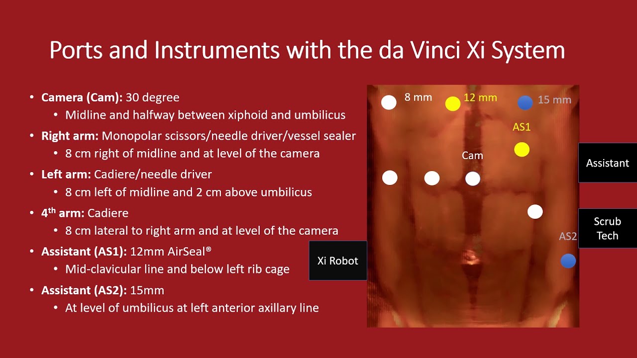 Core Videos (2020): Robotic Intracorporeal Urinary Diversion Ileal ...