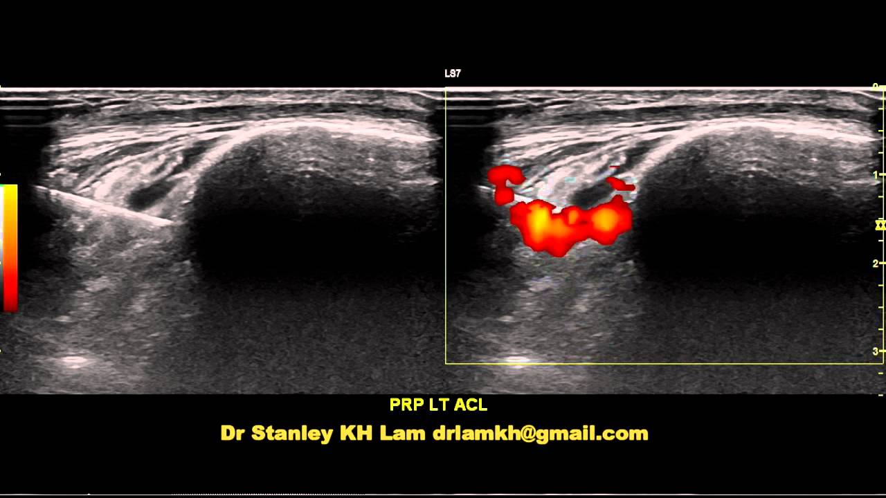 MSK US Guided PRP Injection of ACL - YouTube