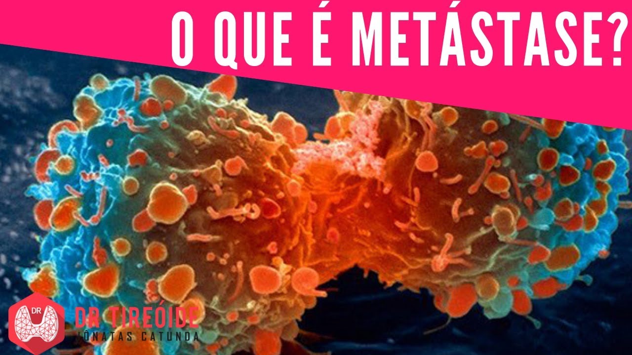 O que é metástase? | Dr Jônatas Catunda - YouTube