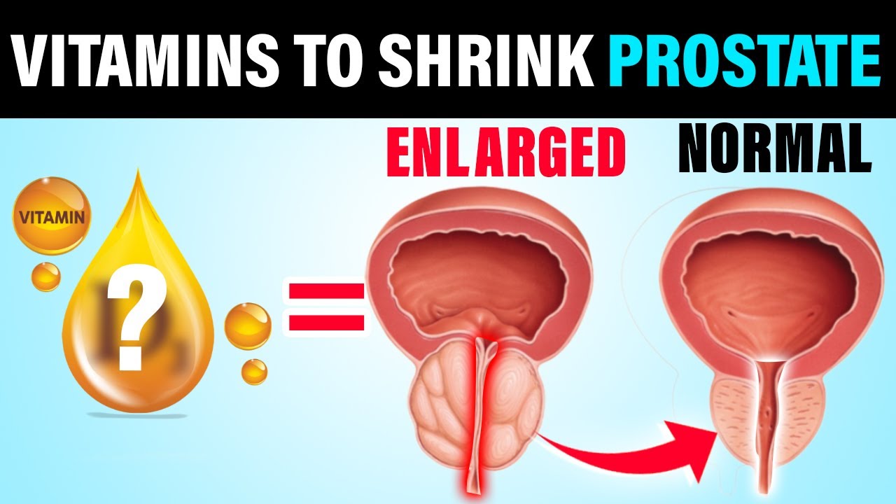 Discover the Vitamins That Naturally Shrink Your Prostate !! Shrink ...