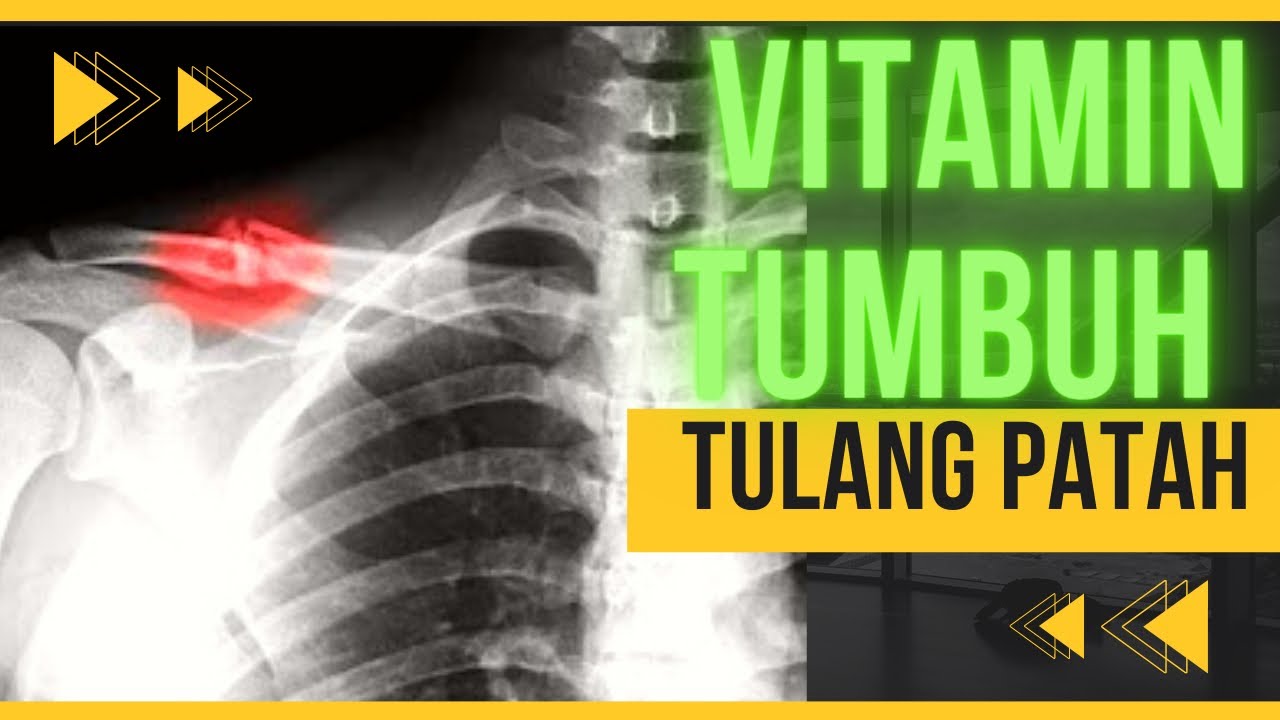 Vitamin Tumbuh Tulang Patah | Pertumbuhan Tulang Baru - YouTube