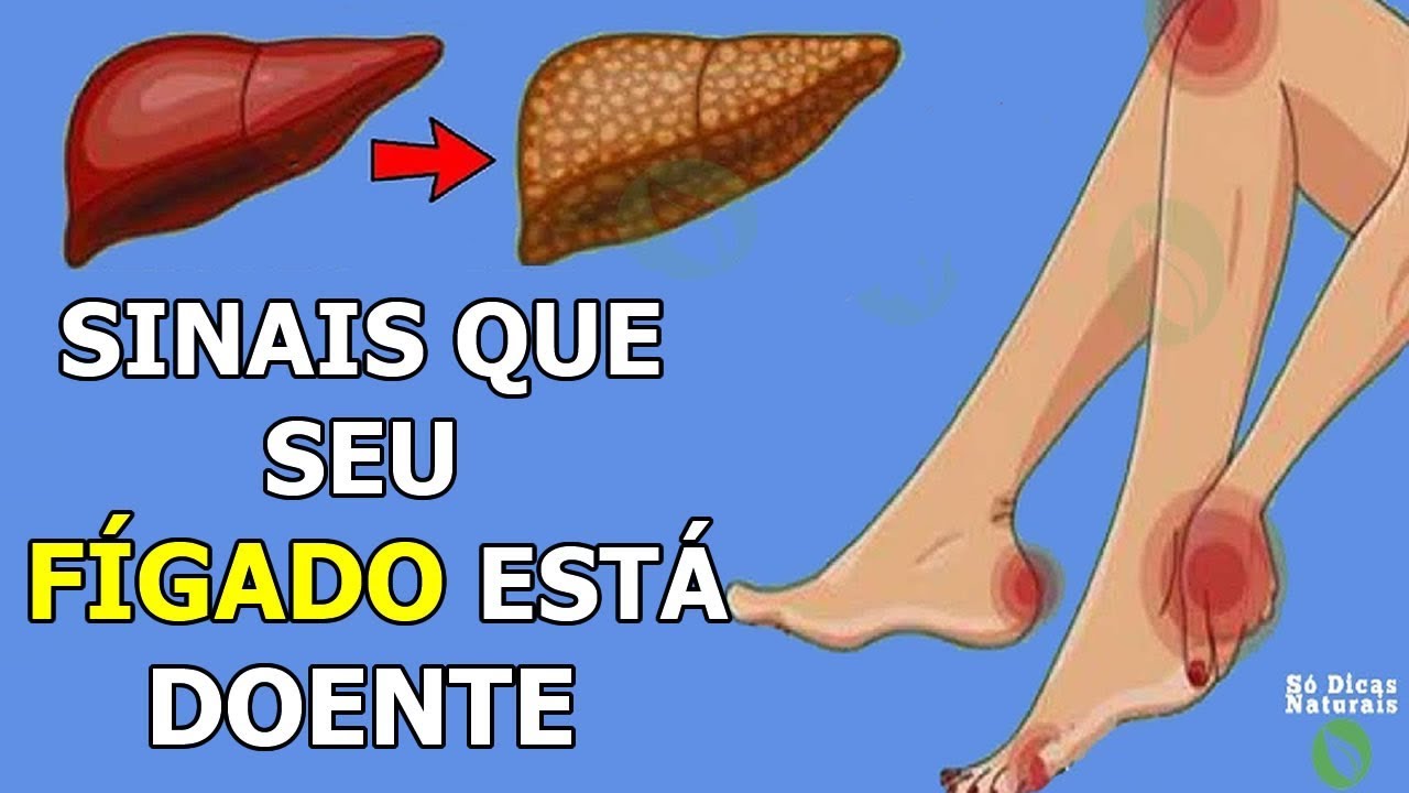 Se Você Tem Esses Sintomas Seu Fígado Pode Estar Sobrecarregado Te ...