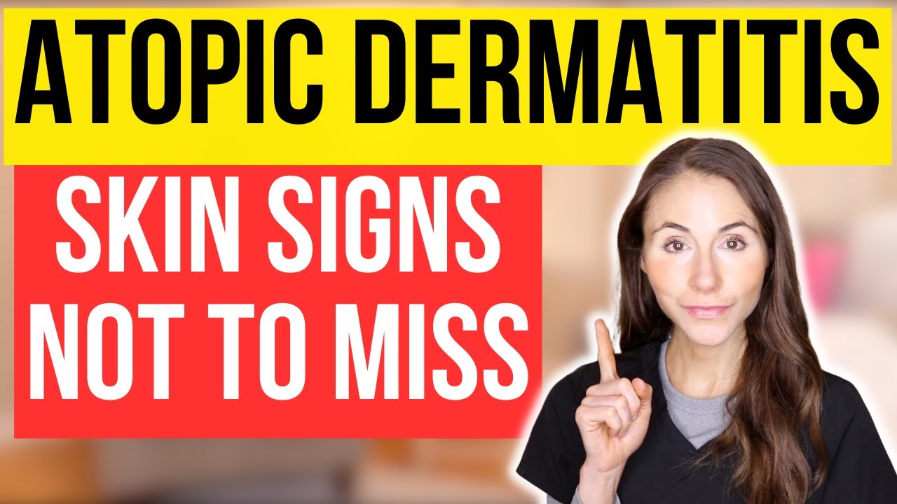 Don't Miss These 15 Signs Of Atopic Dermatitis! - YouTube