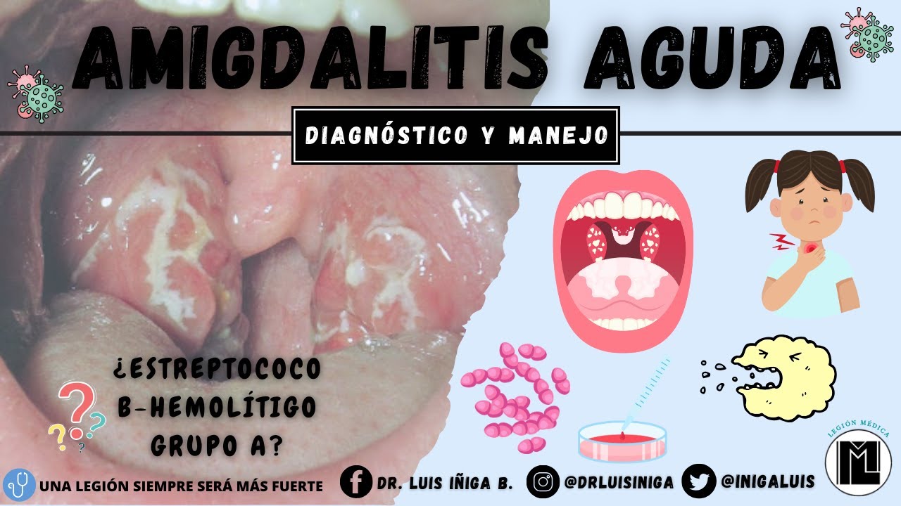 Faringoamigdalitis aguda | Etiología, Patogenia, Clínica, Diagnóstico y ...