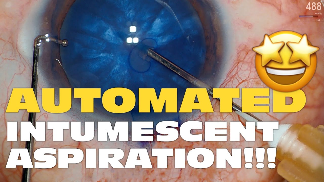 Phaco Clip #204 - Intumescent Cataract Automated Needle Aspiration ...