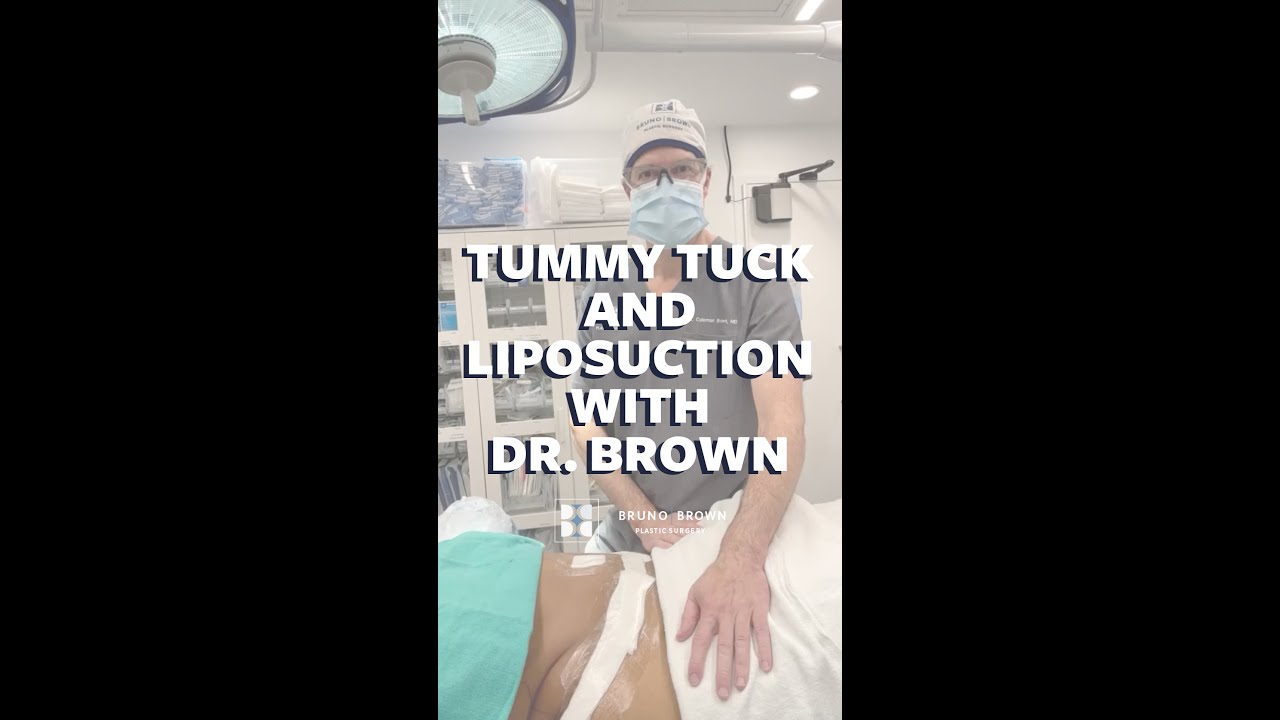 Back Liposuction & Tummy Tuck Transformation [Witness the Tightening ...