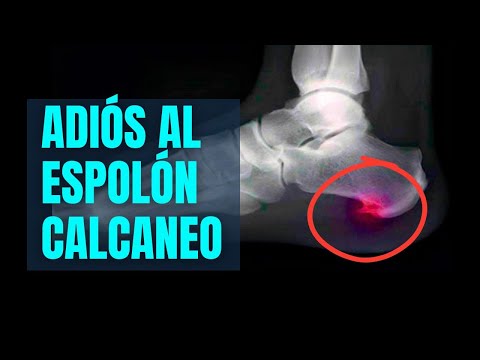 🔥 ¡ADIÓS AL ESPOLÓN CALCÁNEO! 3 Trucos Caseros que REALMENTE Funcionan 🦶❌