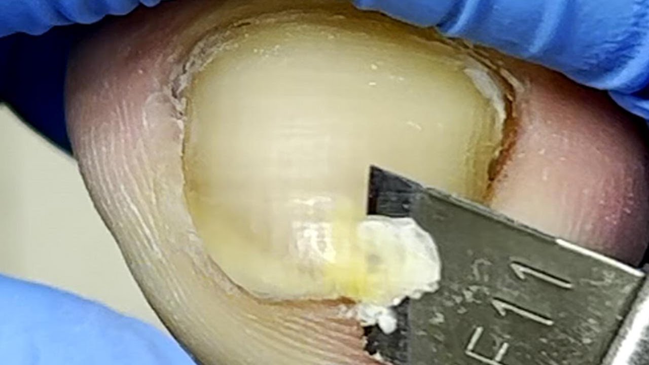 Yellow Toenails Being Trimmed 【xue Yidao Pedicure】 Youtube