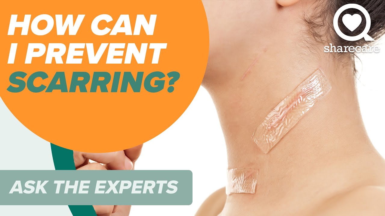 Easy Tips to Prevent Scarring | Ask The Experts | Sharecare - YouTube
