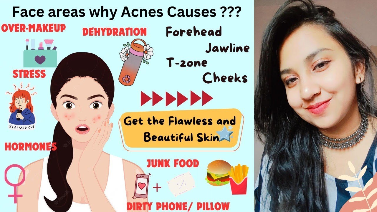Goodbye Forever Acne | Causes of Acne | How to treat acne & pimples ...
