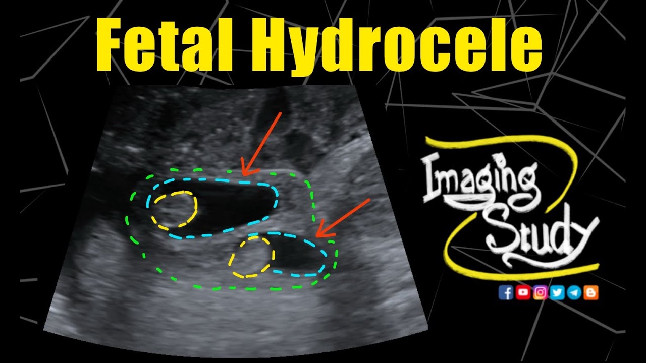Fetal Bilateral Hydrocele || Ultrasound || Case 315 - YouTube
