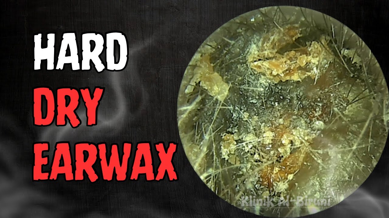 HARD Dry Earwax - YouTube