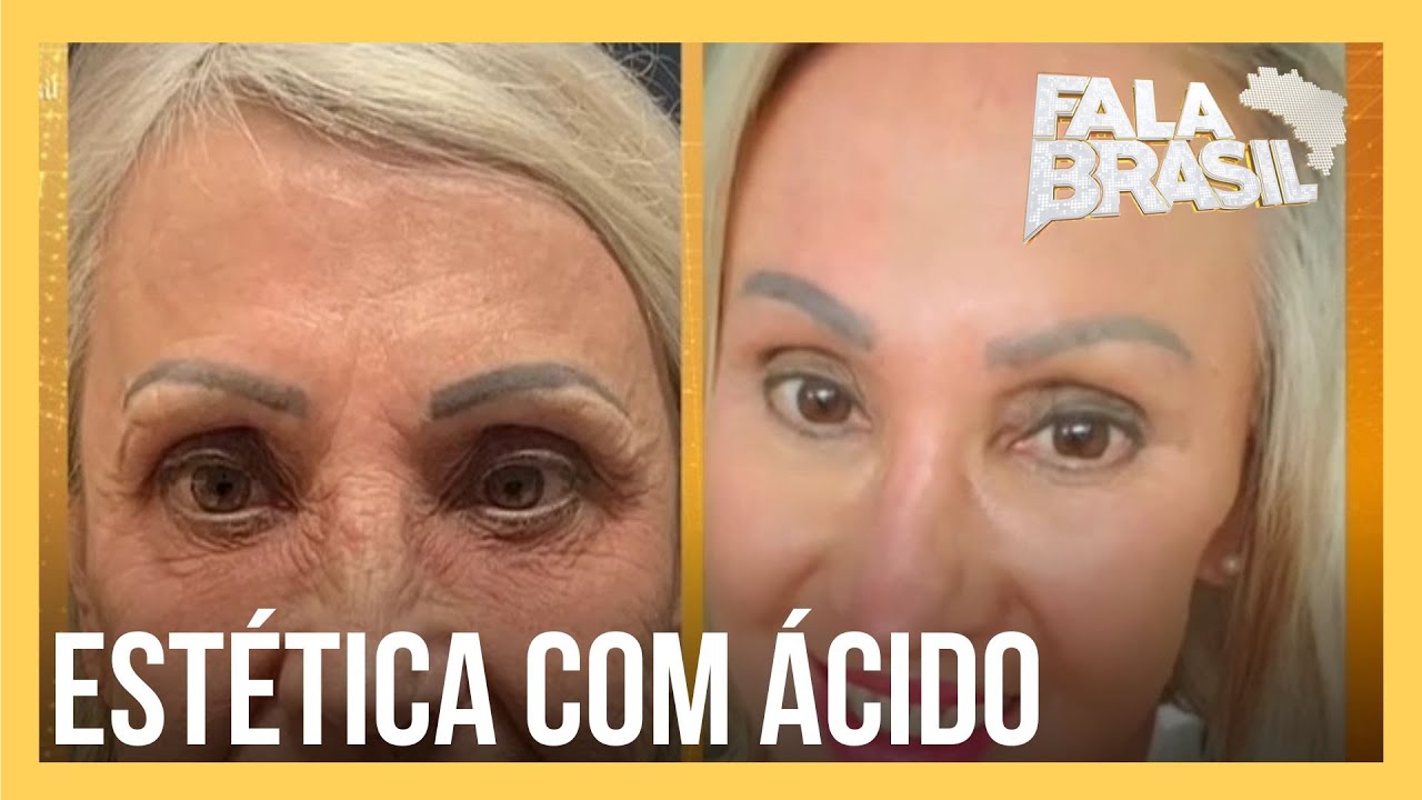 Peeling de fenol: tratamento com ácido tem riscos e é dolorido - YouTube