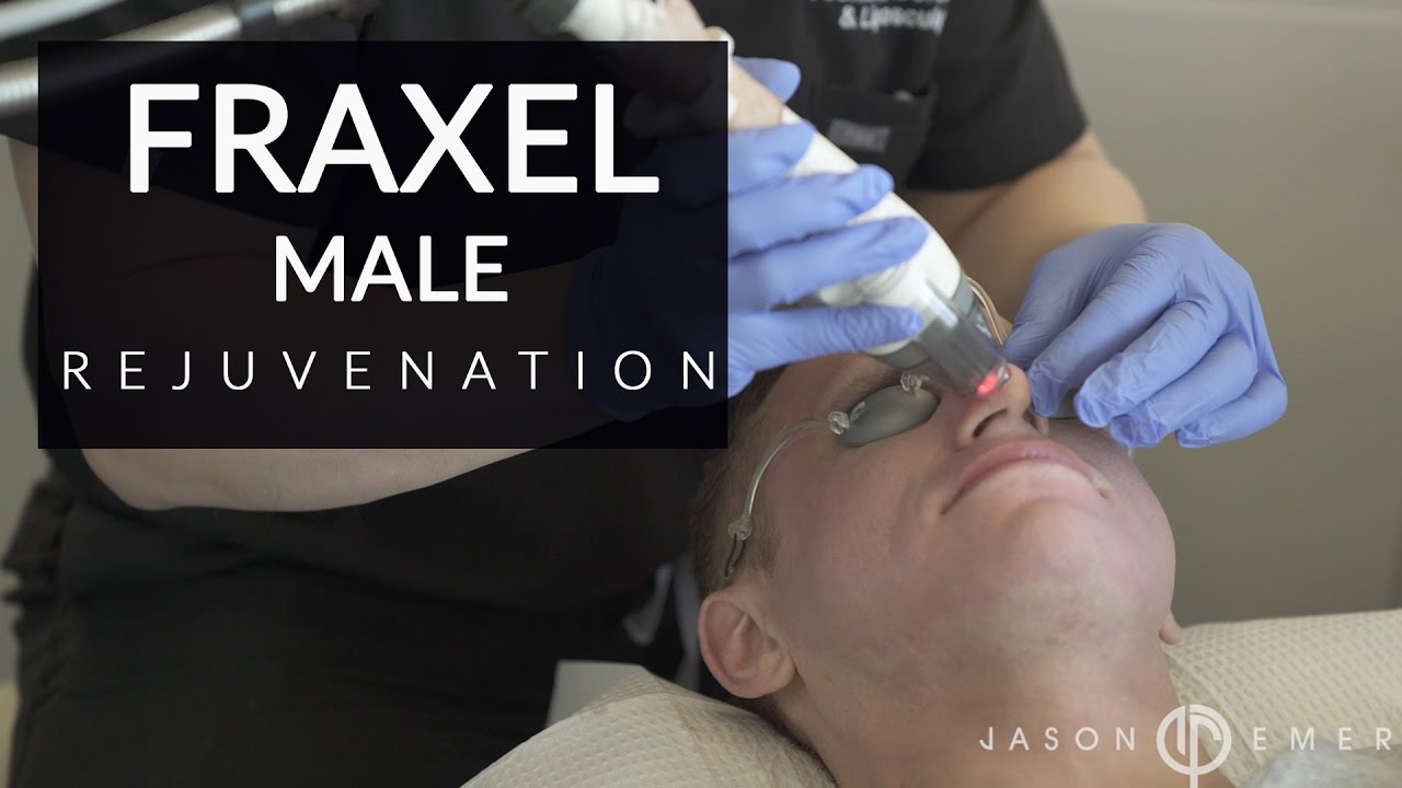 Fraxel Laser Treatment for Male Rejuvenation | Beverly Hills - YouTube
