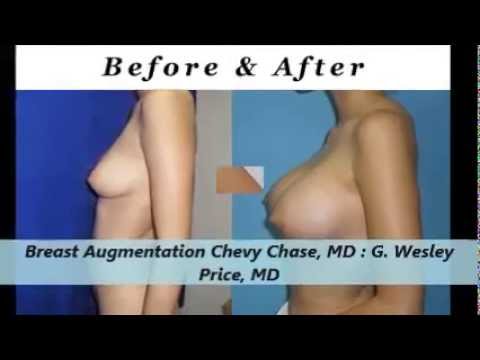 Best Breast Augmentation Woodbridge, Virginia