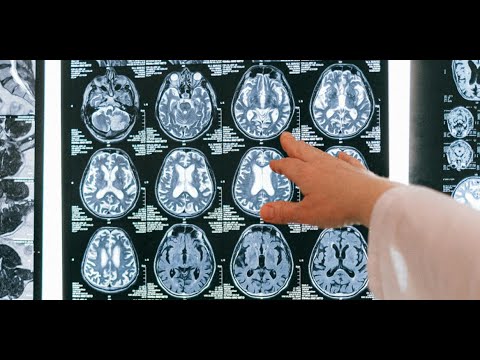 Freehand Frontal EVD Insertion in Case of Small Ventricle: How to ...
