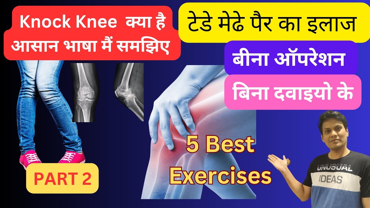 Knock knee correction exercise| ghutne takrane ka ilaz | genu velgum ...