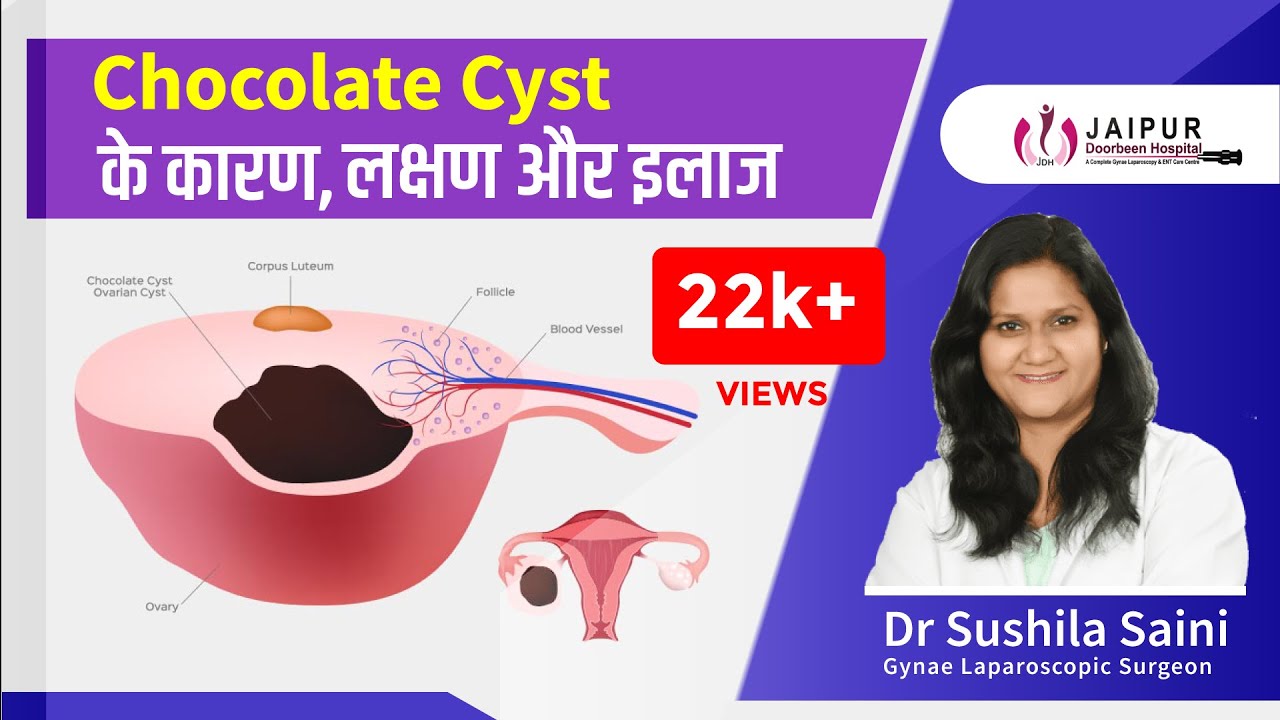 CHOCOLATE CYST के कारण, लक्षण और इलाज | Dr Sushila Saini - YouTube