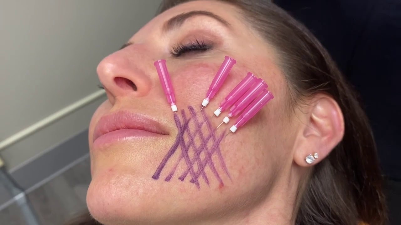 Full Face Treatment with VSoft Lift PDO Threads - YouTube
