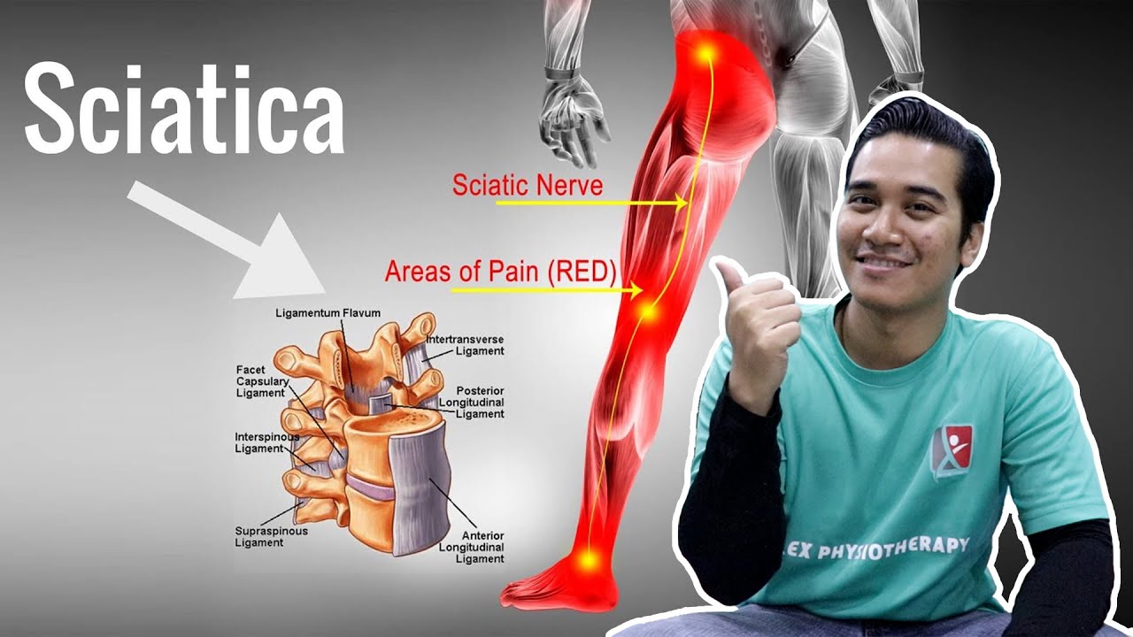 Senaman Untuk Sciatica Pain - YouTube