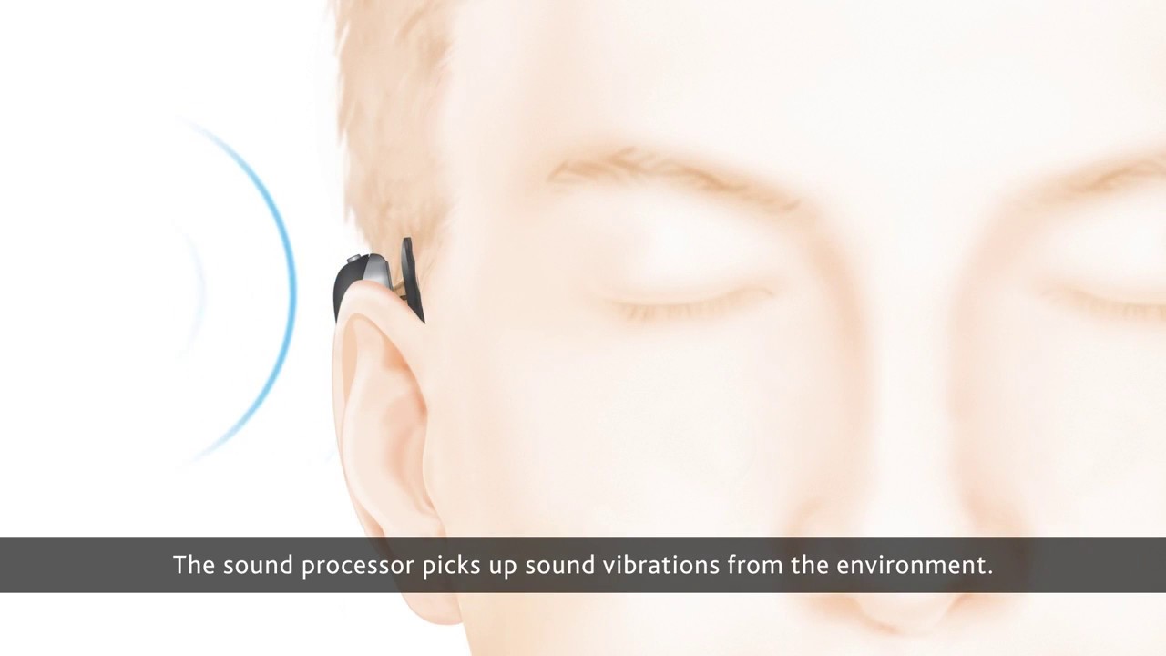 Cochlear™ Baha® Attract System - How it Works - YouTube