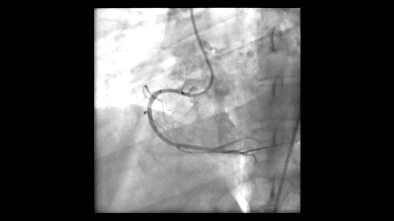 Reverse CART in CTO Prof.Dr.Sami Özgül - YouTube