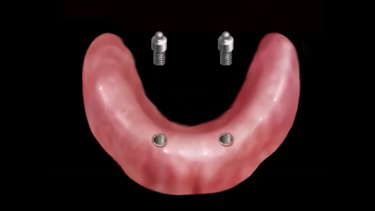 Proteza overdenture na 2 implantach - YouTube