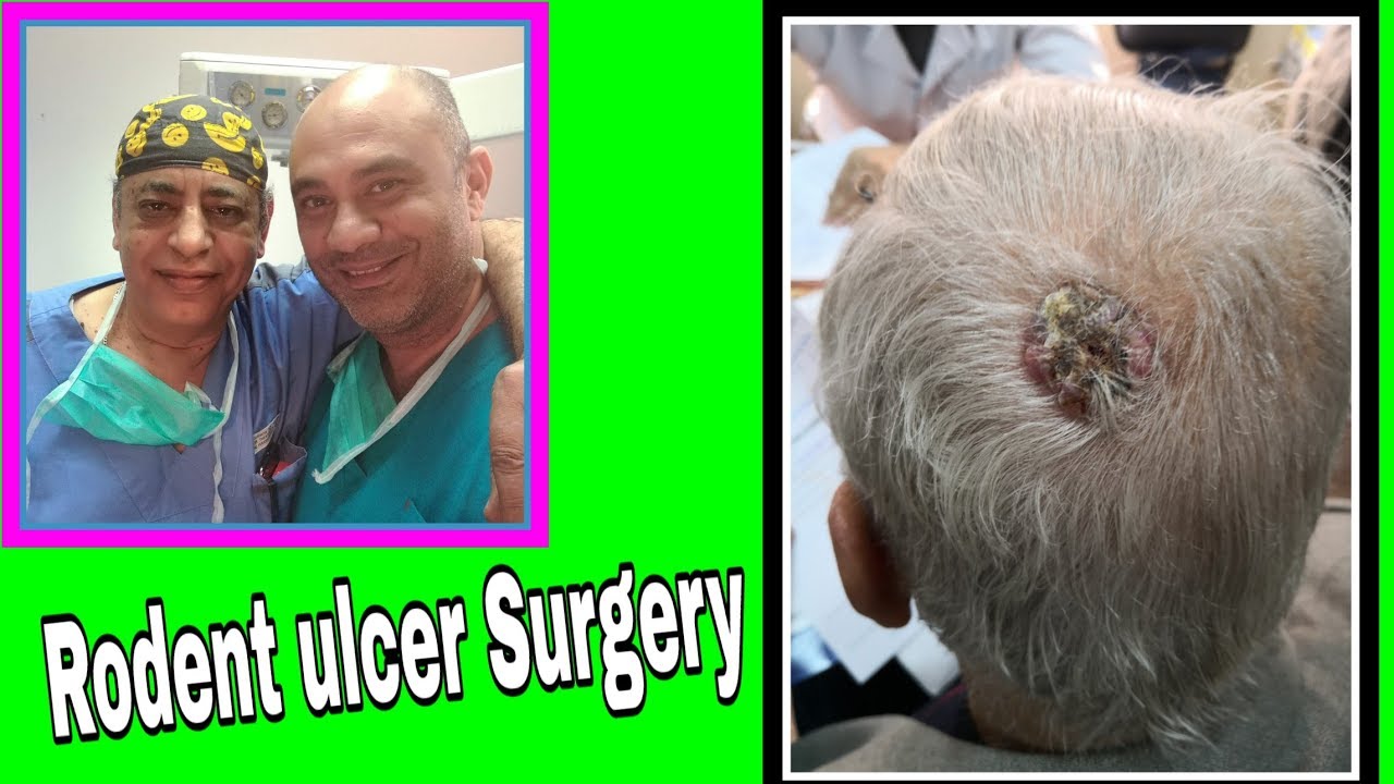Rodent Ulcer Excision with skin Graft Full Operation - YouTube