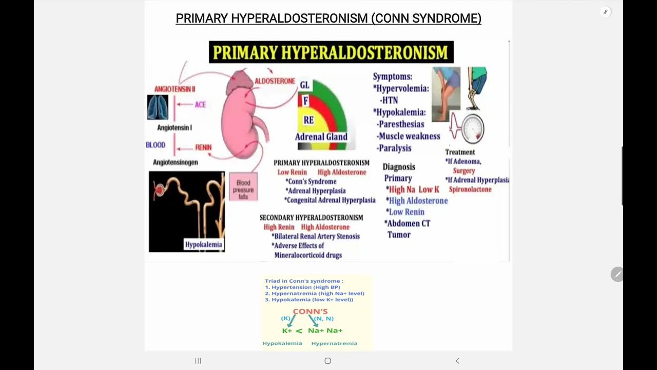 CONN SYNDROME Primary Hyperaldosteronism - YouTube