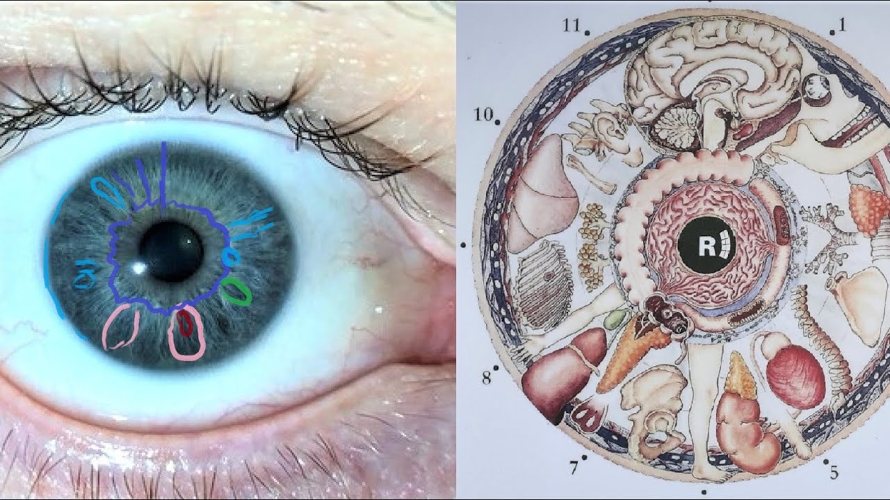 Iris Reading - Brain Fog, Vertigo, Depression & Anxiety, Male ...