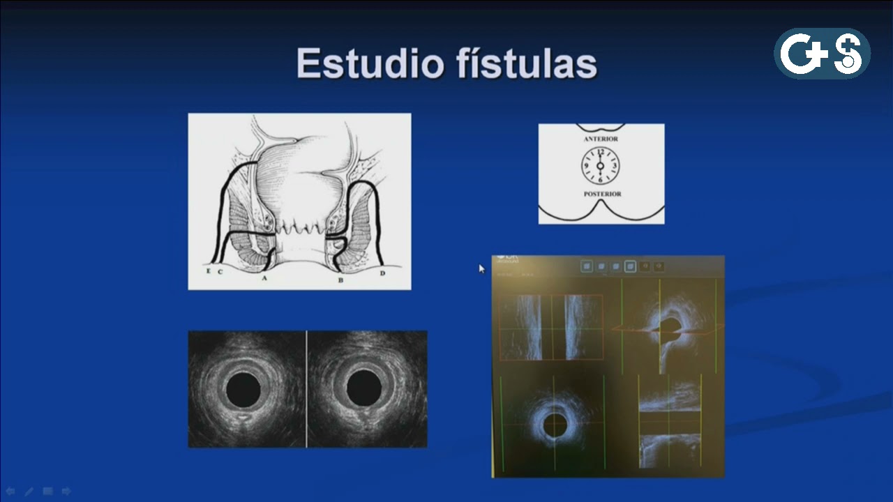 Sesión clínica: Ecografía y Manometría Anal. Indicaciones y resultados ...