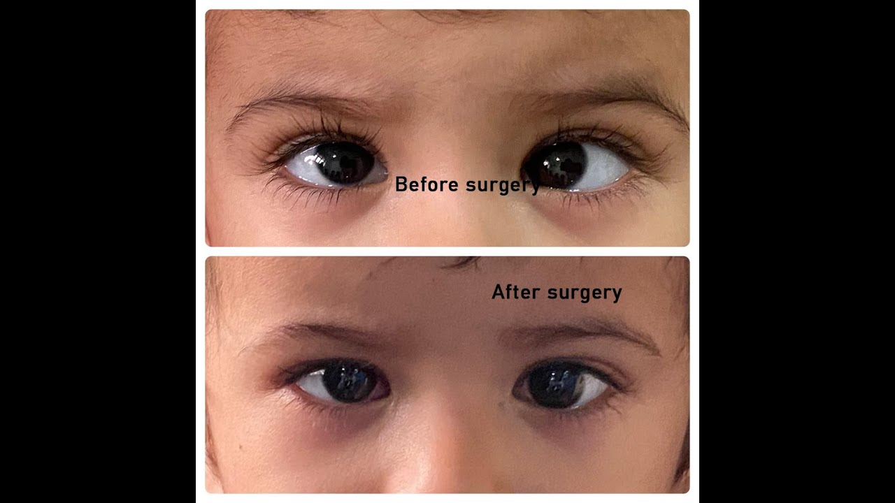 ISSUE 35 squint eye /strabismus SURGERY. - YouTube