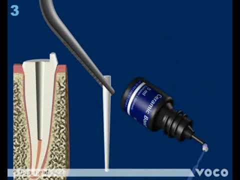 Rebilda Post System Postendodontische Versorgung - YouTube