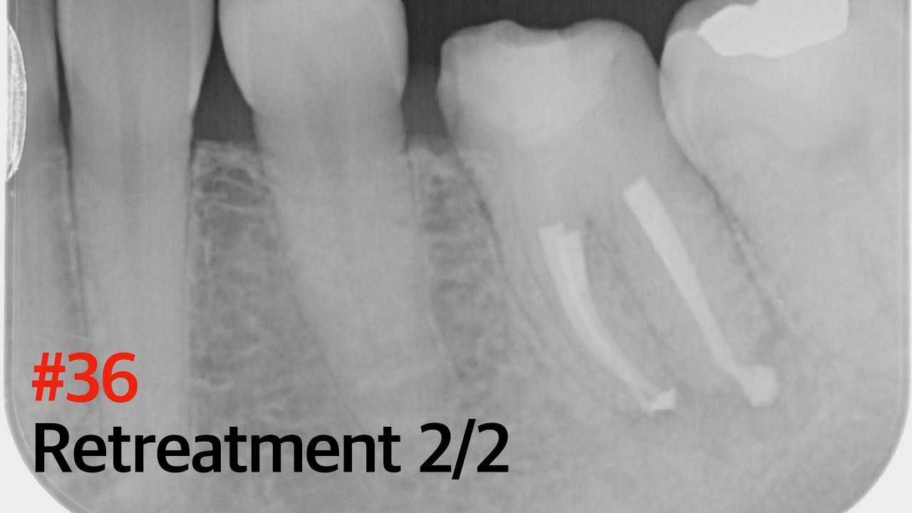 #36 | Mandibular Molar Retreatment with Microscope (2/2) - YouTube