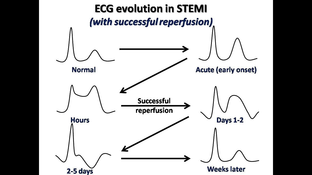 ECG course: ECG in STEMI, Dr. Sherif Altoukhy - YouTube