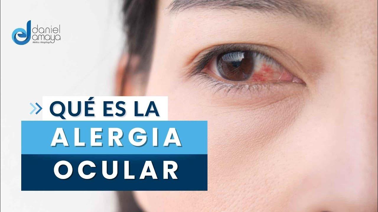 ¿qué Es La Alergia Ocular Conjuntivitis Alérgica I Alergias En Los