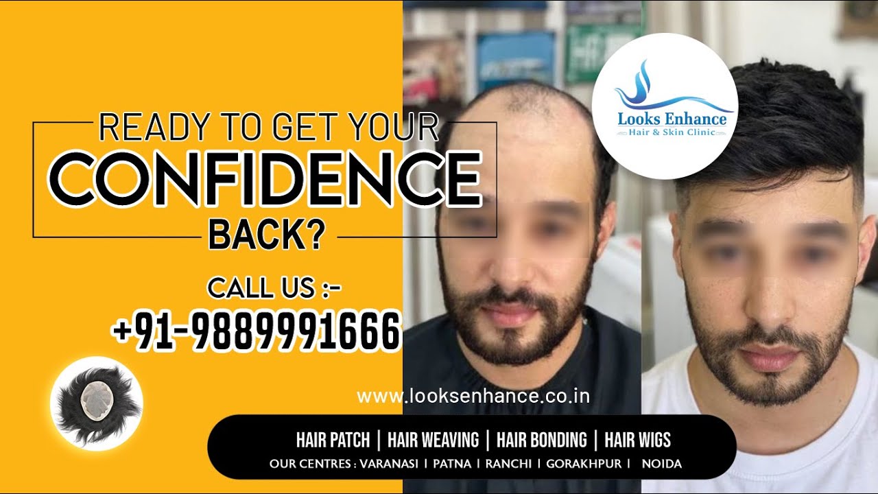 Hair Patch & Hair Wigs in Ranchi | Hair Weaving in Ranchi | Hair Patch ...